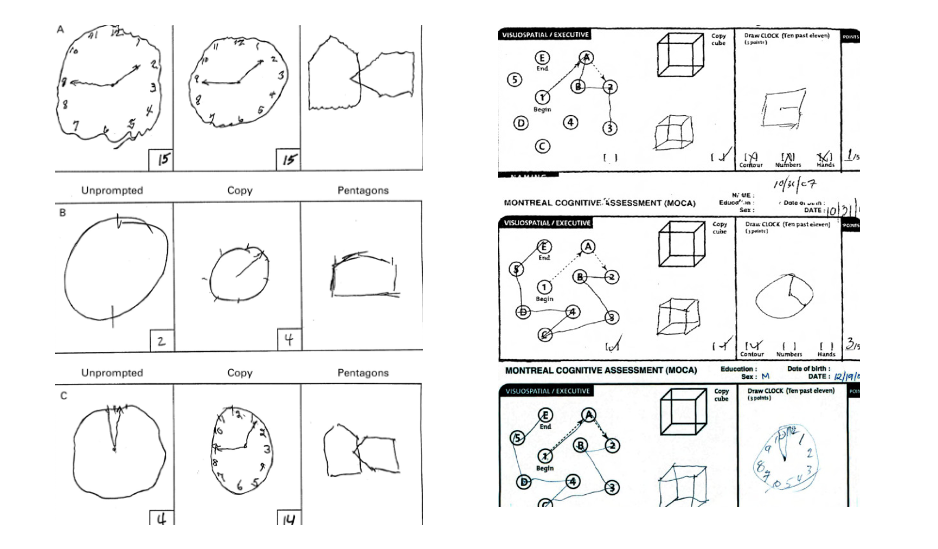 Contrasto Bungalow Singolo Montreal Cognitive Assessment Moca Sbagliato